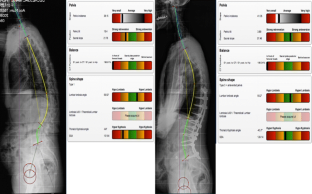 Classification of normal sagittal spine alignment: refounding the ...