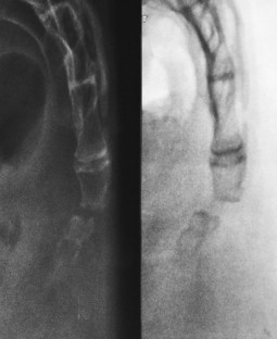 Classification of fractures of the coccyx from a series of 104 patients ...