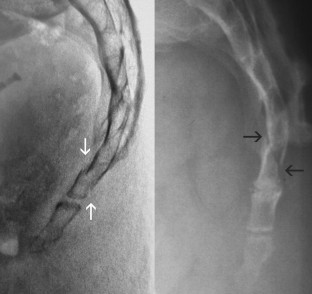 Classification of fractures of the coccyx from a series of 104 patients ...