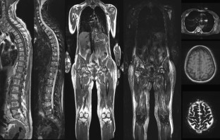 Multiples Myelom | SpringerLink