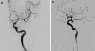 Differential diagnosis of infundibular dilation versus a small aneurysm ...