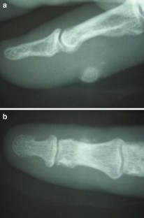 Silver nitrate masquerading as a radiopaque foreign body | SpringerLink