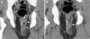 CT of acute perianal abscesses and infected fistulae: a pictorial essay ...