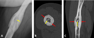 Osteomyelitis of the lower extremity: pathophysiology, imaging, and ...