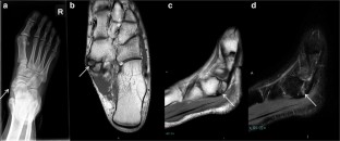Accessory ossicles of the foot—an imaging conundrum | SpringerLink