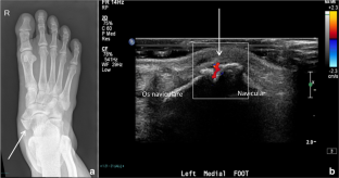 Accessory ossicles of the foot—an imaging conundrum | SpringerLink