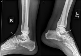Accessory ossicles of the foot—an imaging conundrum | SpringerLink