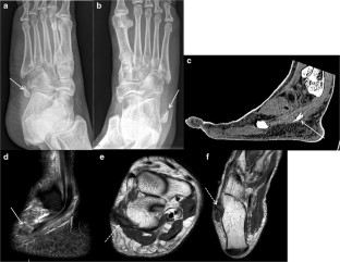 Accessory ossicles of the foot—an imaging conundrum | SpringerLink