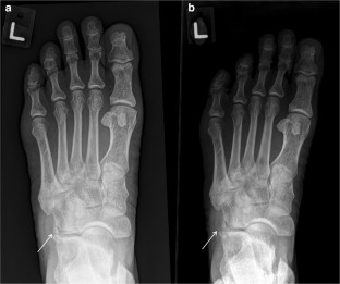 Accessory ossicles of the foot—an imaging conundrum | SpringerLink