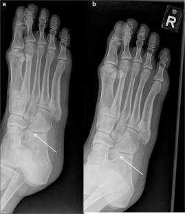 Accessory ossicles of the foot—an imaging conundrum | SpringerLink