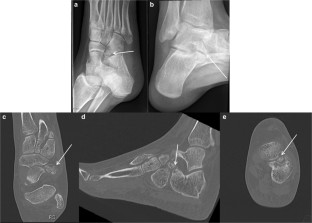 Accessory ossicles of the foot—an imaging conundrum | SpringerLink