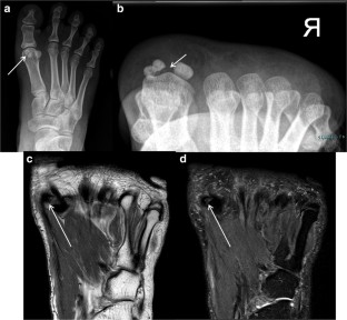 Accessory ossicles of the foot—an imaging conundrum | SpringerLink
