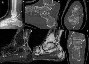 Accessory ossicles of the foot—an imaging conundrum | SpringerLink