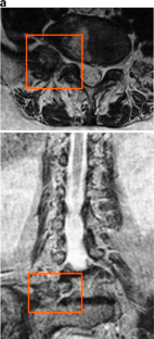 Transitional lumbosacral segment with unilateral transverse process ...