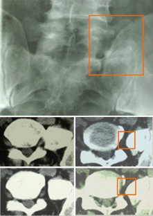 Transitional lumbosacral segment with unilateral transverse process ...