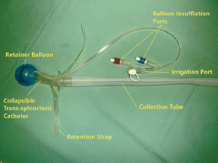A Nonsurgical Means of Fecal Diversion: The Zassi Bowel Management ...
