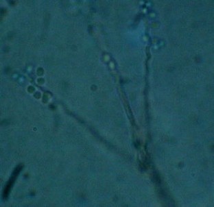 First Report of Tritirachium oryzae Infection of Human Scalp | SpringerLink
