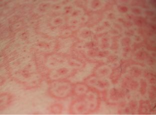 Diabetes mellitus and the skin | SpringerLink