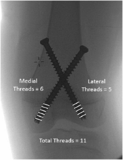 Percutaneous Epiphysiodesis Using Transphyseal Screws: a Case Series ...