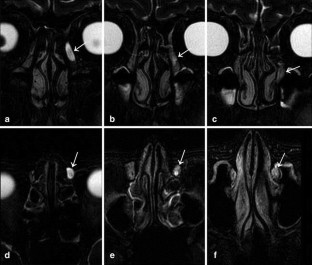 MR dacryocystography: comparison with dacryoendoscopy in positional ...