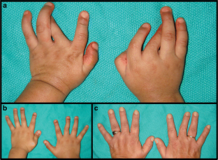 Bilateral proximal delta phalanges: an unusual presentation of familial congenital clinodactyly ...