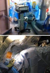 Robot-assisted laparoscopic myomectomy and adenomyomectomy with a ...