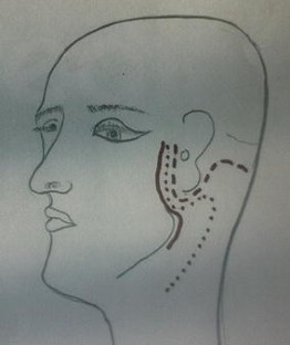 Do we Need to Modify the Parotidectomy Incision? | Indian Journal of ...
