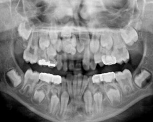 Compound Odontoma | SpringerLink