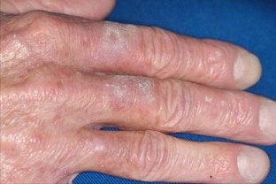 Bazex Syndrome (Acrokeratosis Paraneoplastica) Diagnosed in a Patient ...