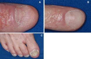 Bazex Syndrome (Acrokeratosis Paraneoplastica) Diagnosed in a Patient ...