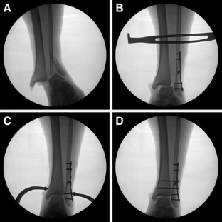 Syndesmosis injuries | SpringerLink