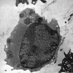 CLL with intra-cytoplasmic lymphocytic inclusion bodies | SpringerLink