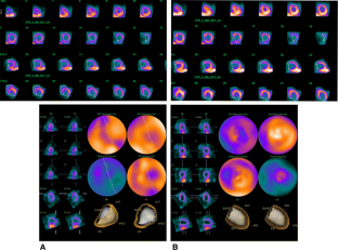Pitfalls and artifacts using the D-SPECT dedicated cardiac camera ...