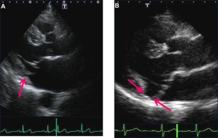 The analysis of mitral annular disjunction detected by echocardiography ...