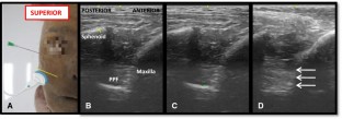Ultrasound-guided maxillary nerve block: an anatomical study using the ...