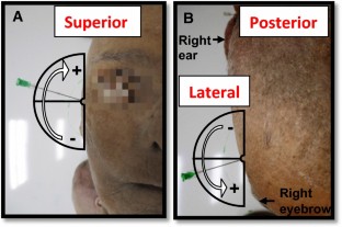 Ultrasound-guided maxillary nerve block: an anatomical study using the ...