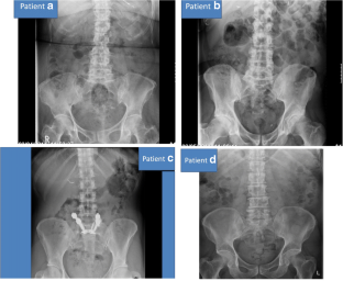 Can unrecognized fecal loading without infrequent bowel movements be a ...