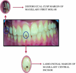 A Cephalometric Study on the Relationship Between the Occlusal Plane ...
