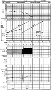 The Partograph in Childbirth: An Absolute Essentiality or a Mere ...
