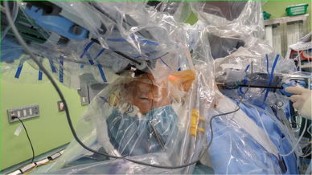 Transoral Robotic Thyroidectomy | SpringerLink