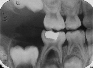 Optimal fit of chairside-fabricated distal shoe space maintainer ...