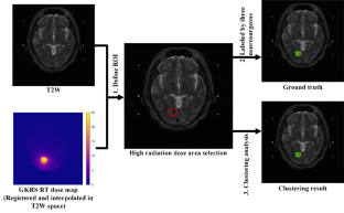 Using Gaussian Mixture Model Clustering for the Automated Segmentation of Cerebral Arteriovenous ...