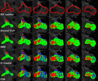 Using Gaussian Mixture Model Clustering for the Automated Segmentation of Cerebral Arteriovenous ...