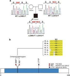 SOFT syndrome caused by compound heterozygous mutations of POC1A and ...