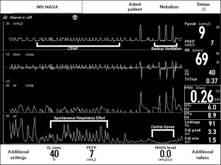 Nasal continuous positive airway pressure versus noninvasive NAVA in ...