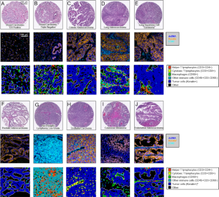 Multiplexed ion beam imaging (MIBI) for characterization of the tumor microenvironment across ...