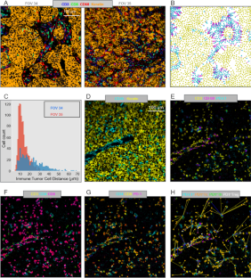 Multiplexed ion beam imaging (MIBI) for characterization of the tumor microenvironment across ...