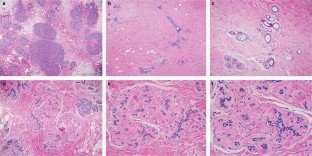 Hyaline fibrous involution of breast lobules: a histologic finding ...
