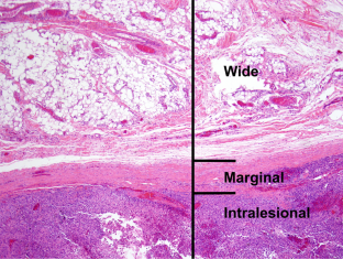 Surgical resection margin classifications for high-grade pleomorphic ...