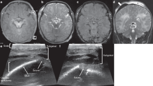Encephalopathy in neonates with subgaleal hemorrhage is a key predictor ...